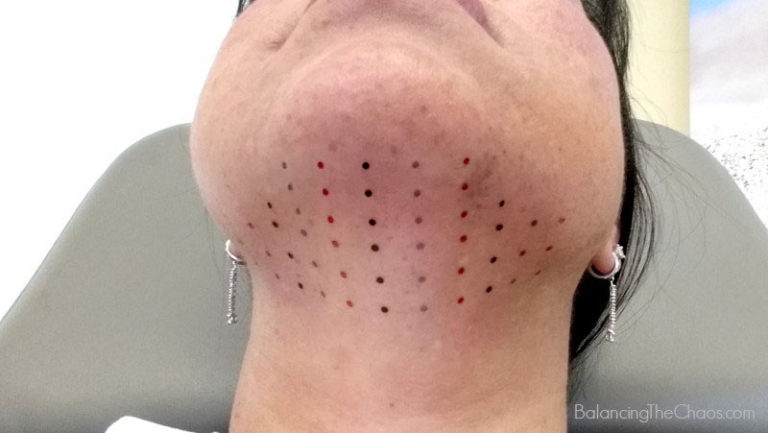 My First Treatment - Kybella | @CosmetiCare #CosmetiCareMoms #Kybella ...