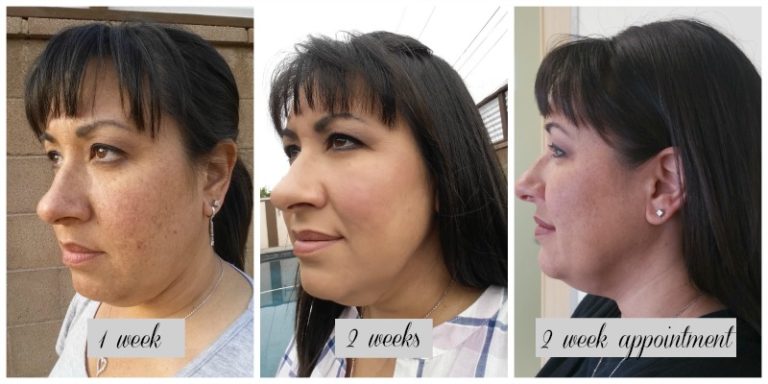Kybella Results - My Transformation with CosmetiCare - Balancing The Chaos